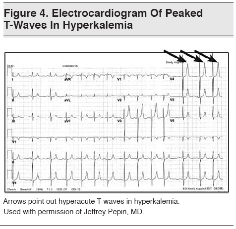Electrocardiogram In Hyperkalemia